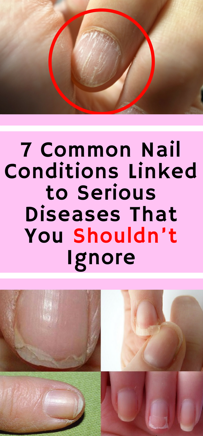 Run Healthy Lifestyle: 7 COMMON NAIL CONDITIONS LINKED TO SERIOUS ...