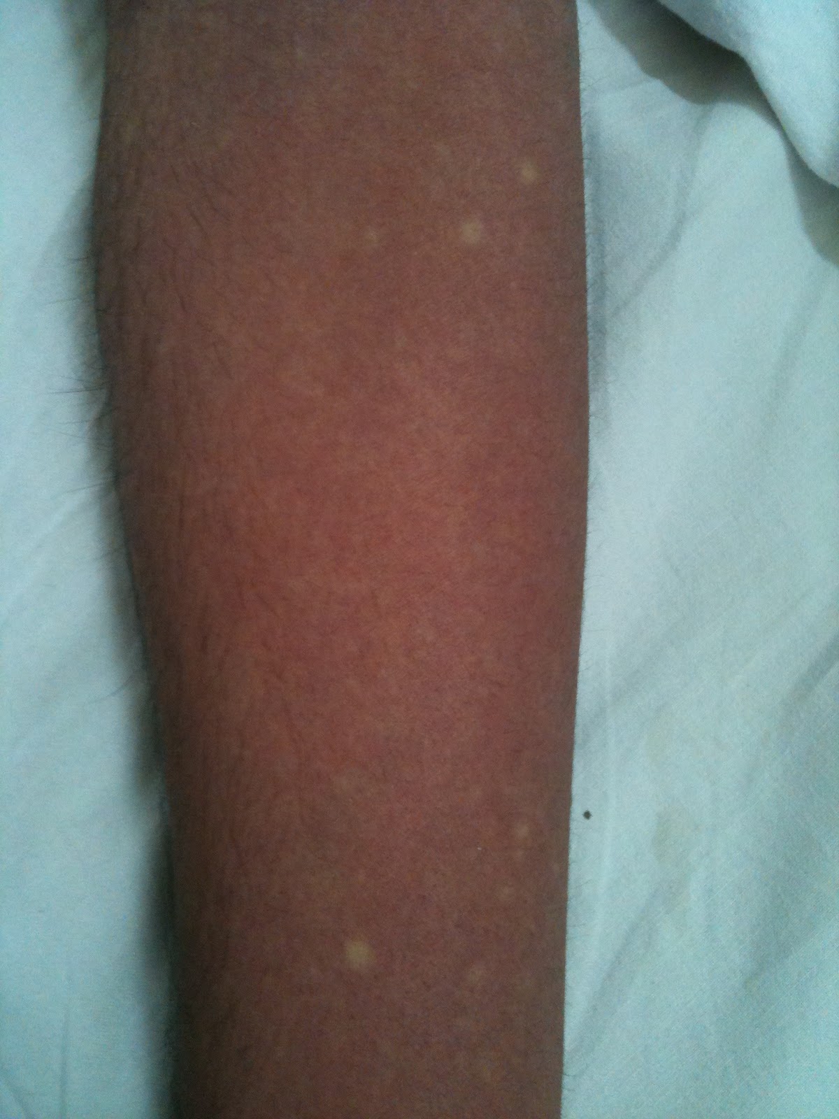 Medical MCQ Center: Skin MCQs for MCCEE, MCCQE