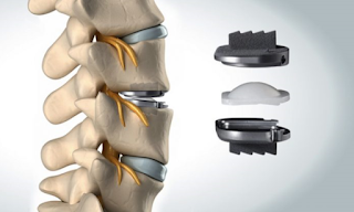 Lombalgies: REMPLACEMENT D'UN DISQUE INTERVERTEBRAL