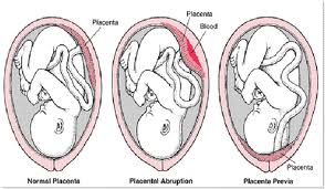 RumahBidan: SOLUSIO PLASENTA