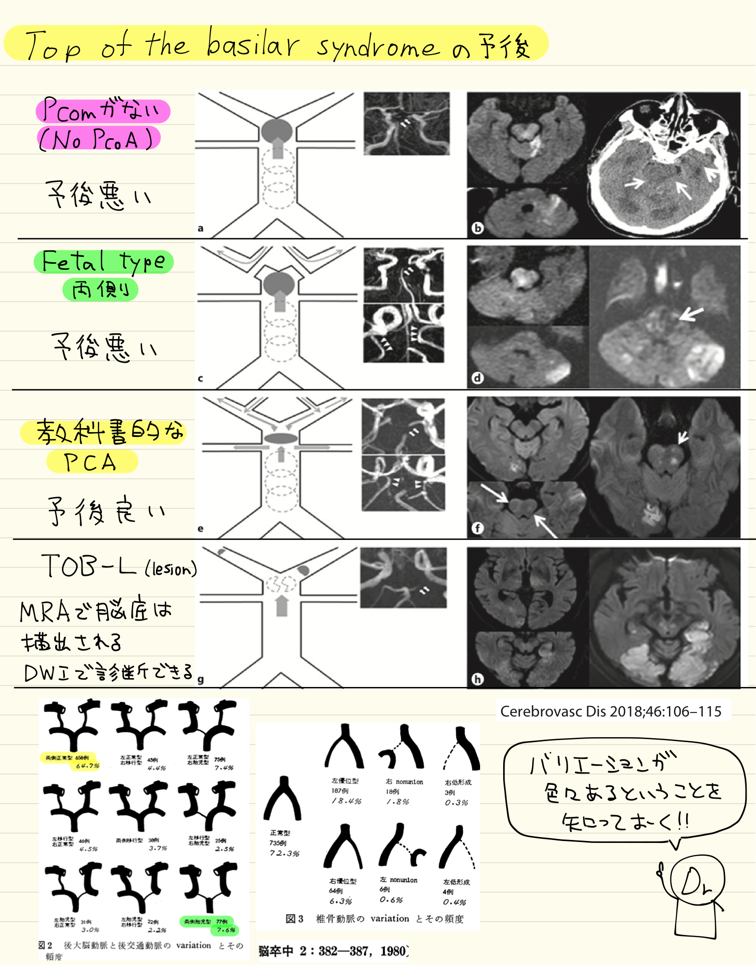 Dr Note〜いつも心に〜: Top of the basilar syndrome 〜一見、脳梗塞に見えない時も〜