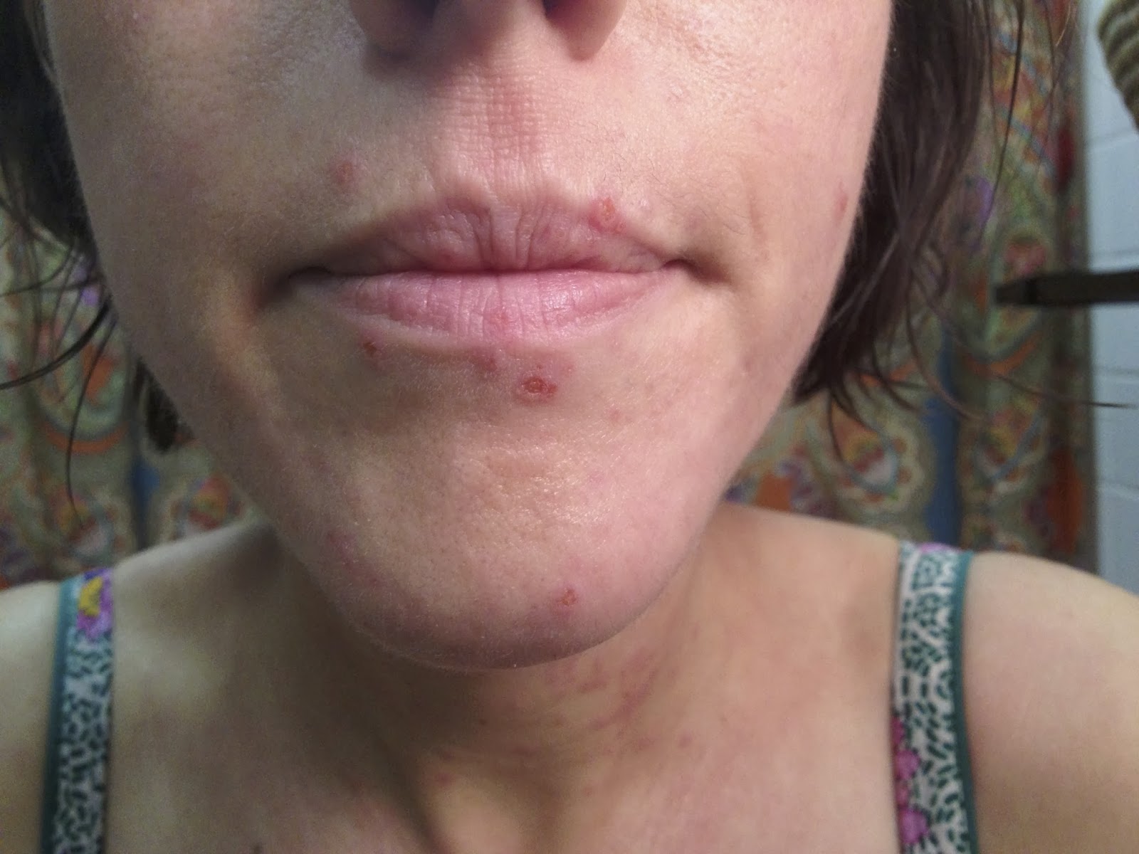 My journey with itchy skin.: Remember that one time: Eczema Herpeticum