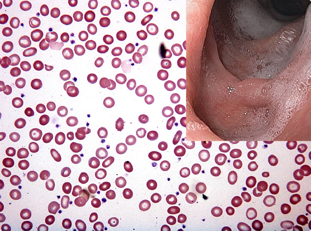 What Is Thrombocytosis? - Teroes