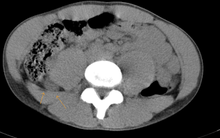 Appendicitis-CT - Sumer's Radiology Blog