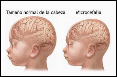 MONOSOMIA DEL 21: CARACTERÍSTICAS CLÍNICAS