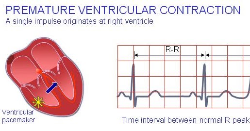 Phimaimedicine: 1,304. Premature ventricular contractions (PVCs)