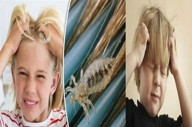 Head Lice: Symptoms and Causes -Home Remedies for Treating Head Lice