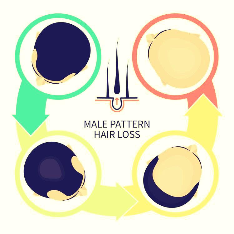 AGA-Male Pattern Baldness