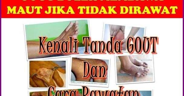 Pengedar Shaklee Ipoh: Tanda-tanda GOUT dan Rawatan Penyakit Gout