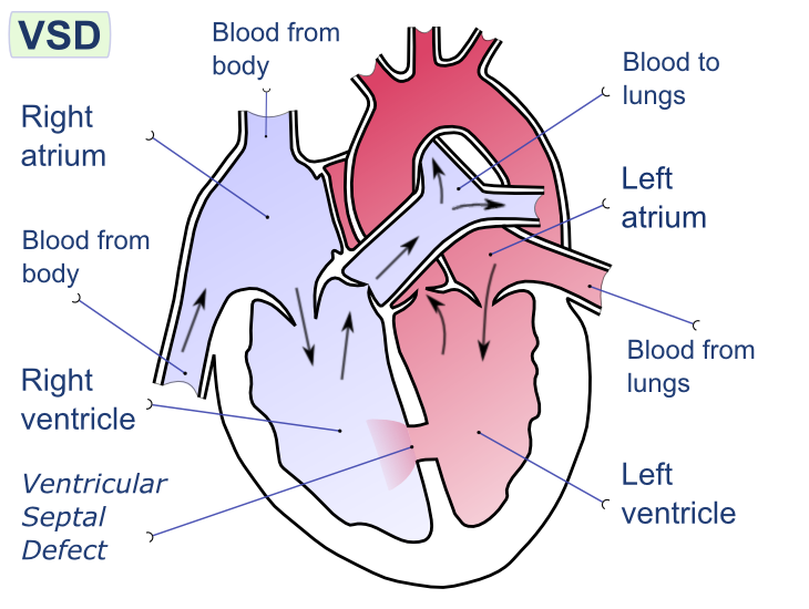Cardio Surgery: Ventricular septal defect VSD