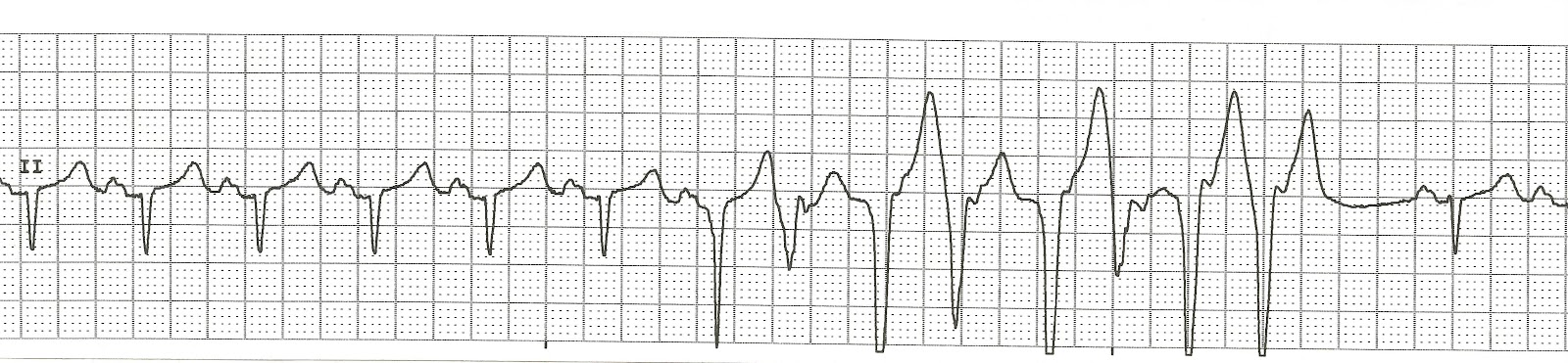 EKG Rhythm Strip Quiz 88