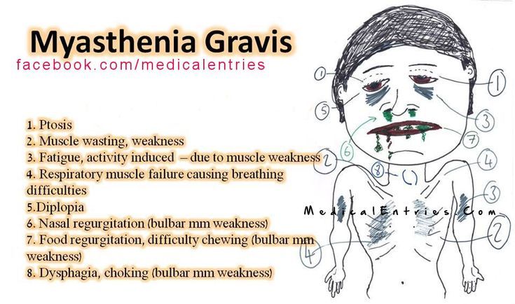 myasthenia gravis,symptoms,diagnosis,treatment