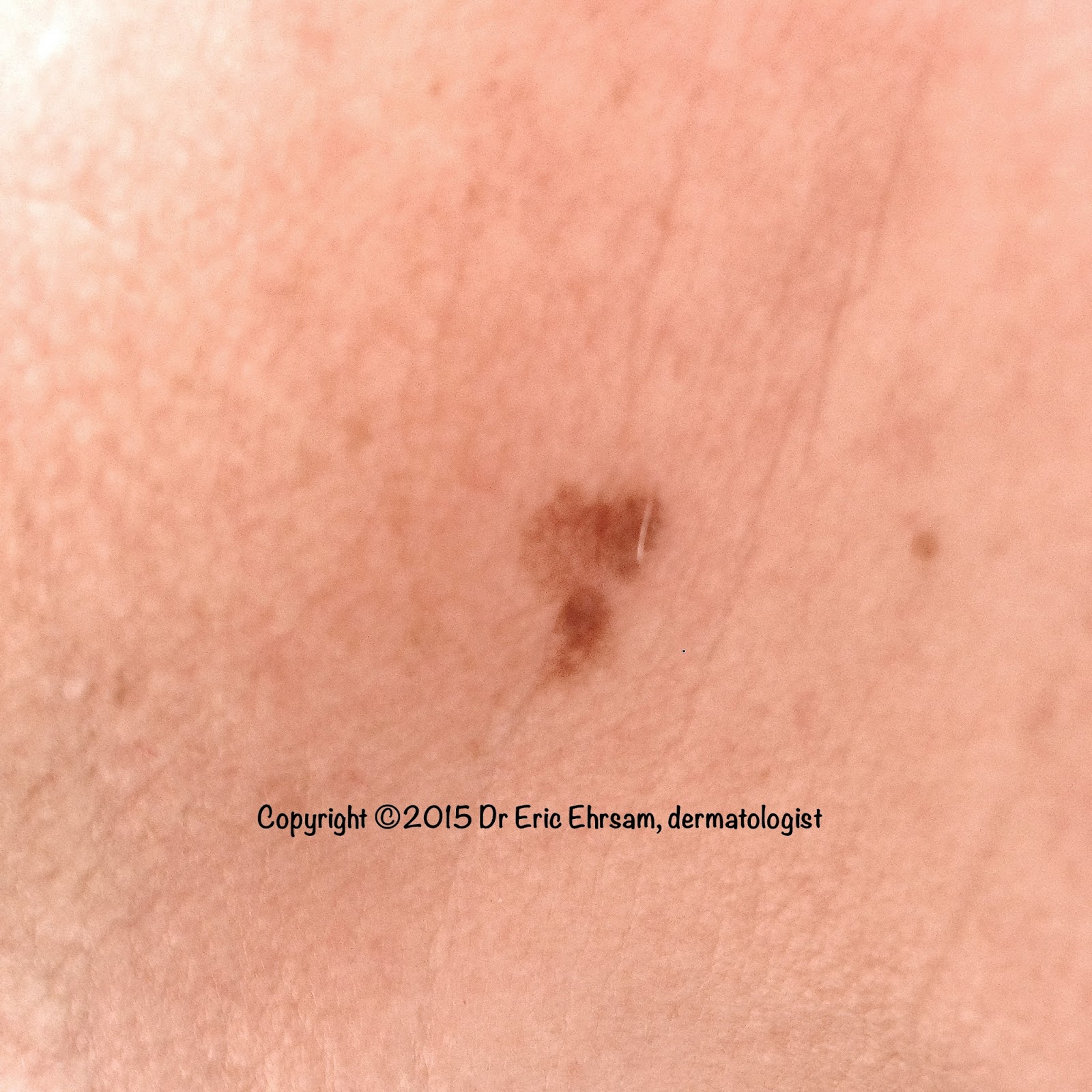 dermoscopy: Pigmented lesion on neck.