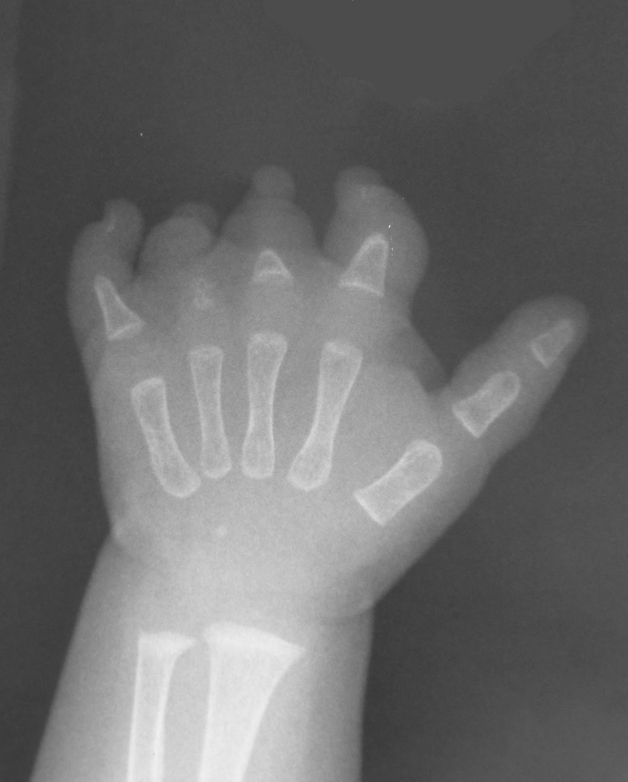 Toe Transfers | Congenital Hand and Arm Differences | Washington ...