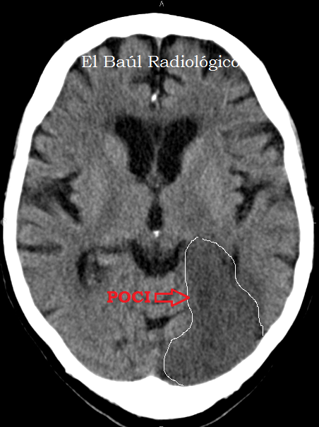 El Baúl Radiológico: ICTUS: UN GALIMATÍAS DE SIGLAS (Stroke: A ...