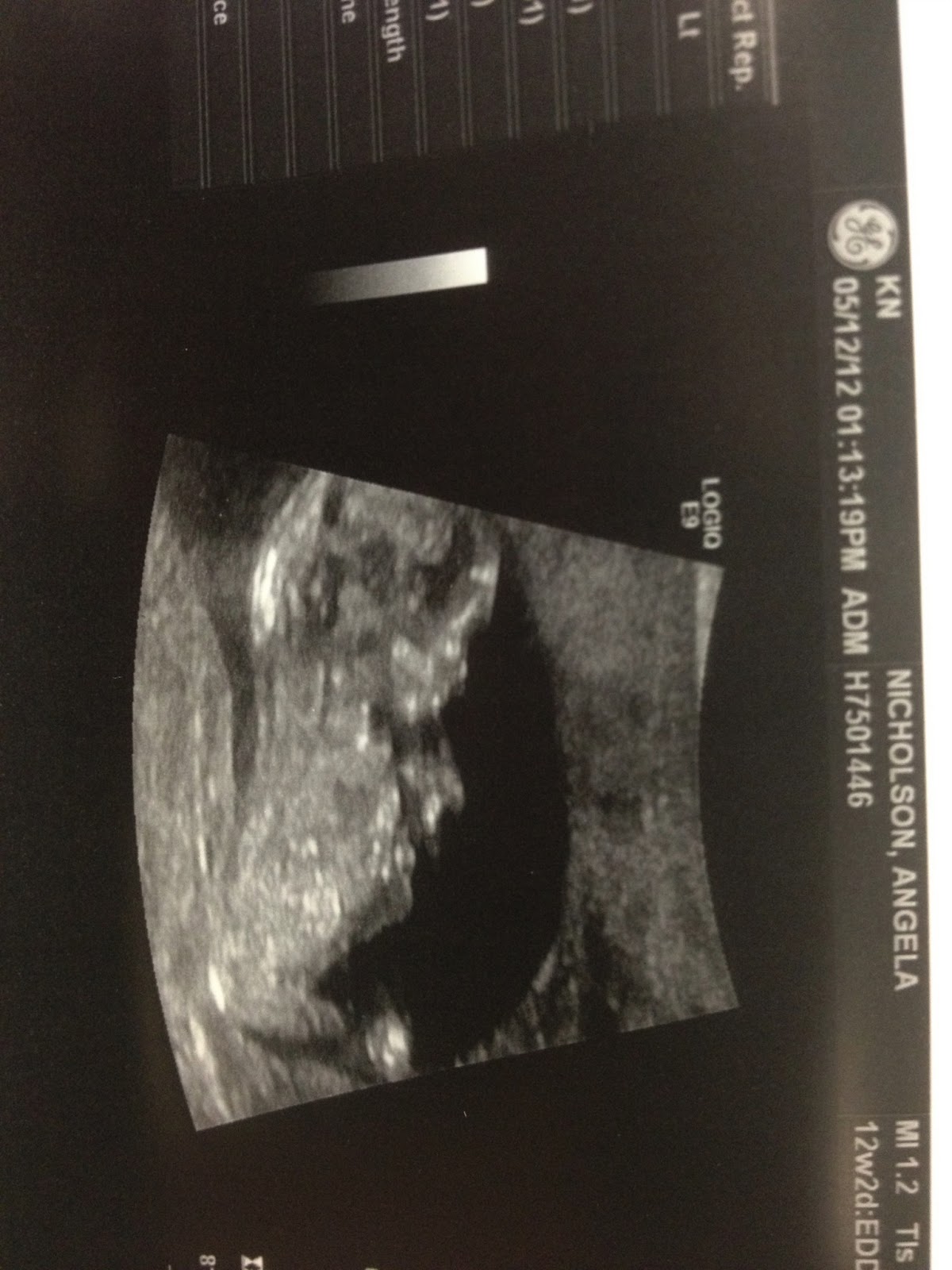 Our Journey Through Pregnancy: 12 Week Scan