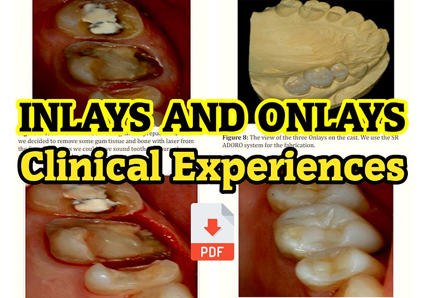 PDF: Inlays and Onlays - Clinical Experiences and Literature Review