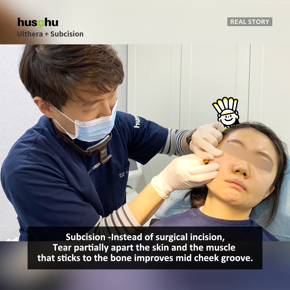 Hushu Dermatology: Mid Cheek Groove treatment-Real Story