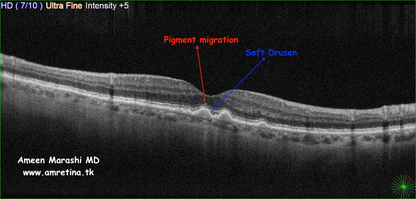 Drusen in non-neovascular ARMD and subtypes