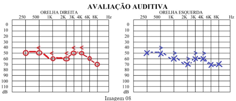 Audiometria Tonal Liminar