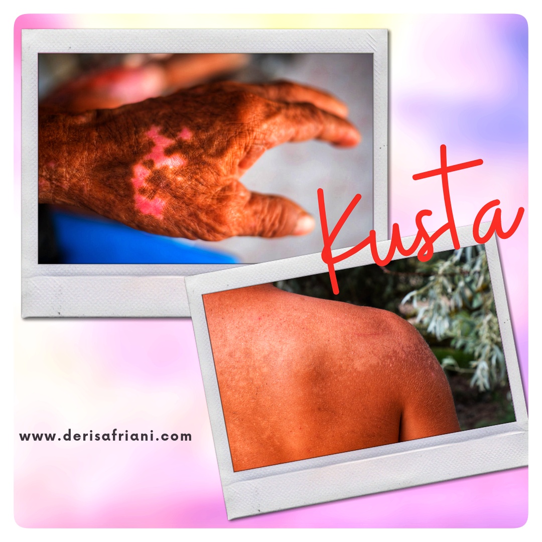 Kusta Tidak Mudah Menular