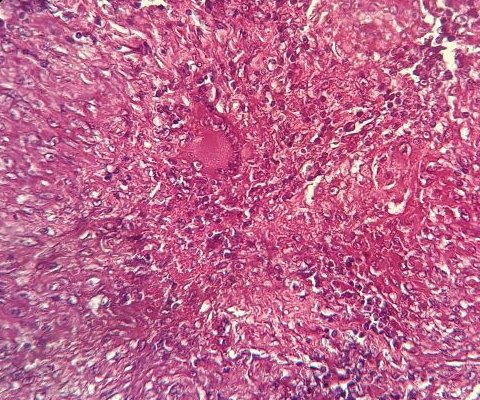 into the roots: Sarcoidosis