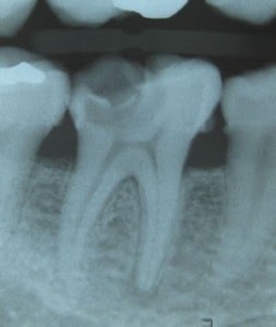 Health Teller: Pulp Hyperemia