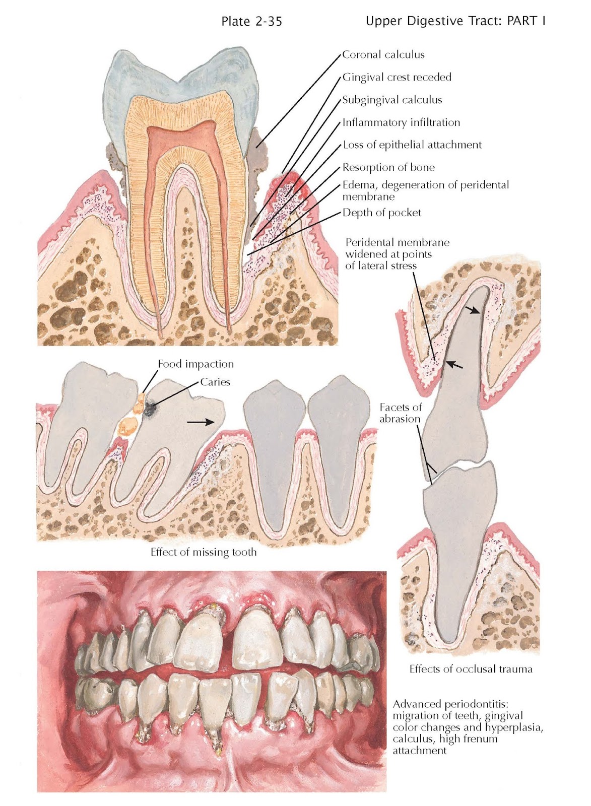 Periodontal Disease - pediagenosis