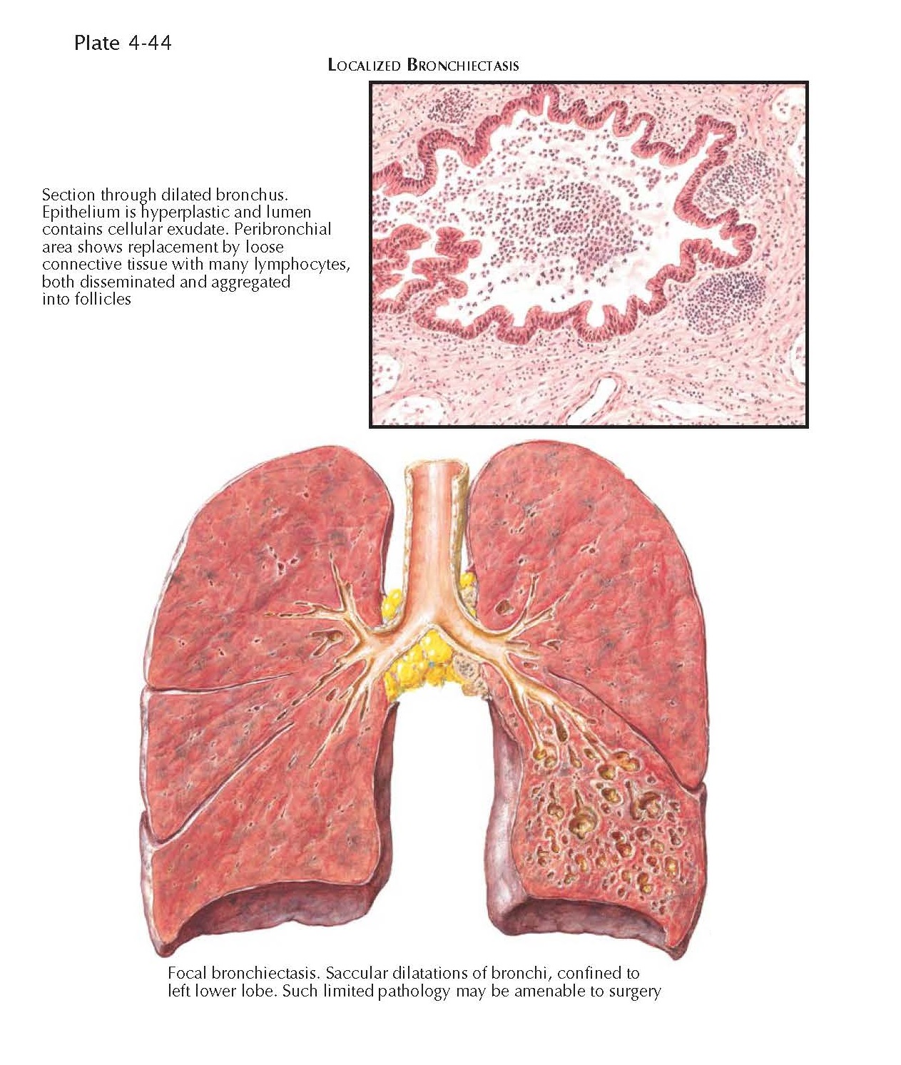 BRONCHIECTASIS - pediagenosis