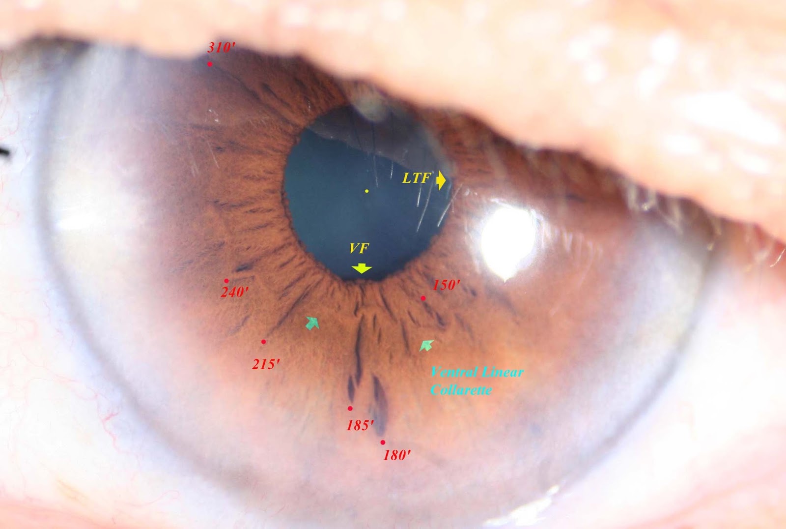 Modern & Multidimensional Iridology: Pupil Flattenings, Embryological ...