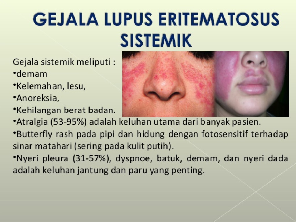 Perawatan Lupus Eritematosus Sistemik - Perumperindo.co.id