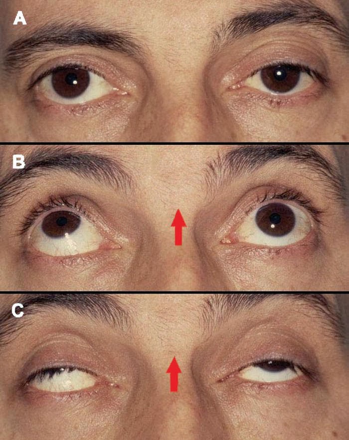 Discapacidad y salud: Miastenia Gravis