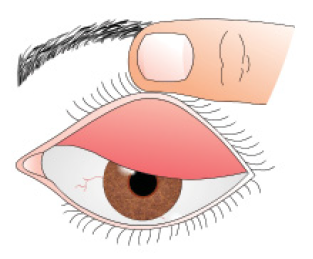Examination of conjunctiva