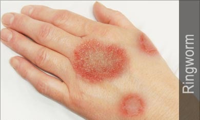 Study Medical Photos: Introduction to Dermatophytosis