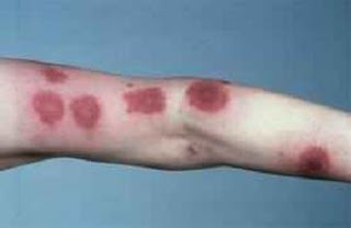 Health And Beauty Tips: Symptoms of Acute myelogenous leukemia (AML)