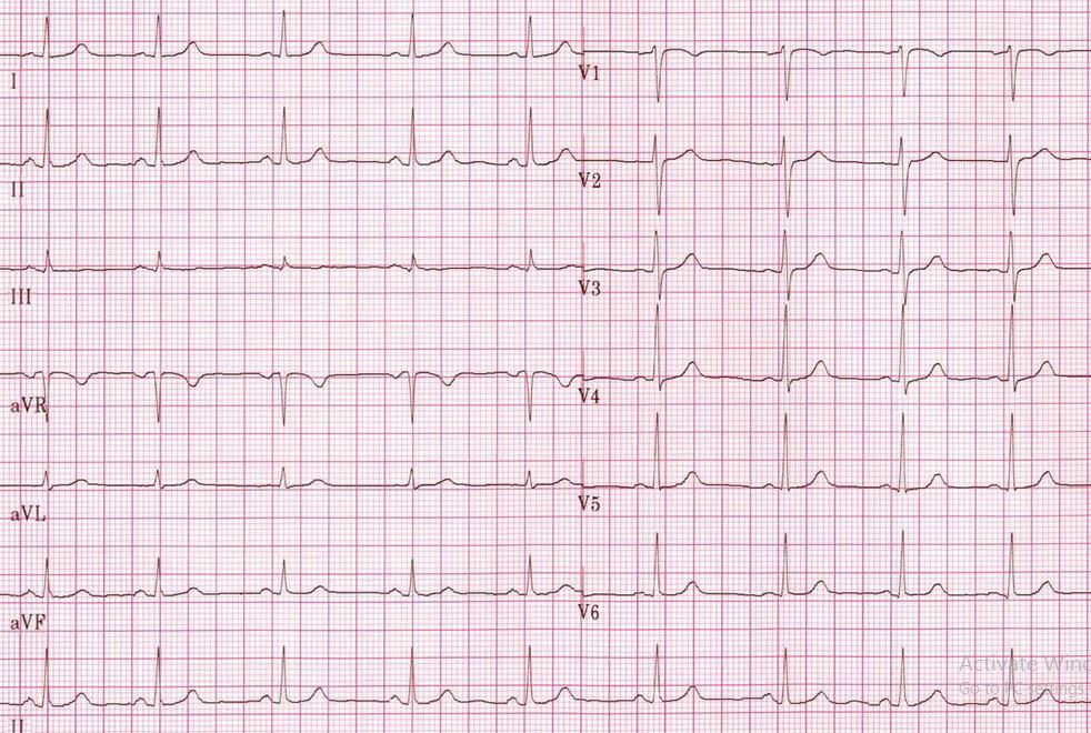Gambaran Tracking EKG yang Normal