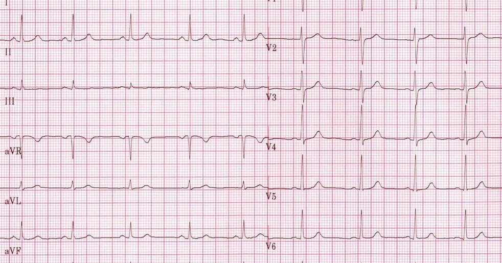 Gambaran Tracking EKG yang Normal