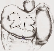 Medical Treatment Pictures-for Better Understanding: Maze Procedure ...