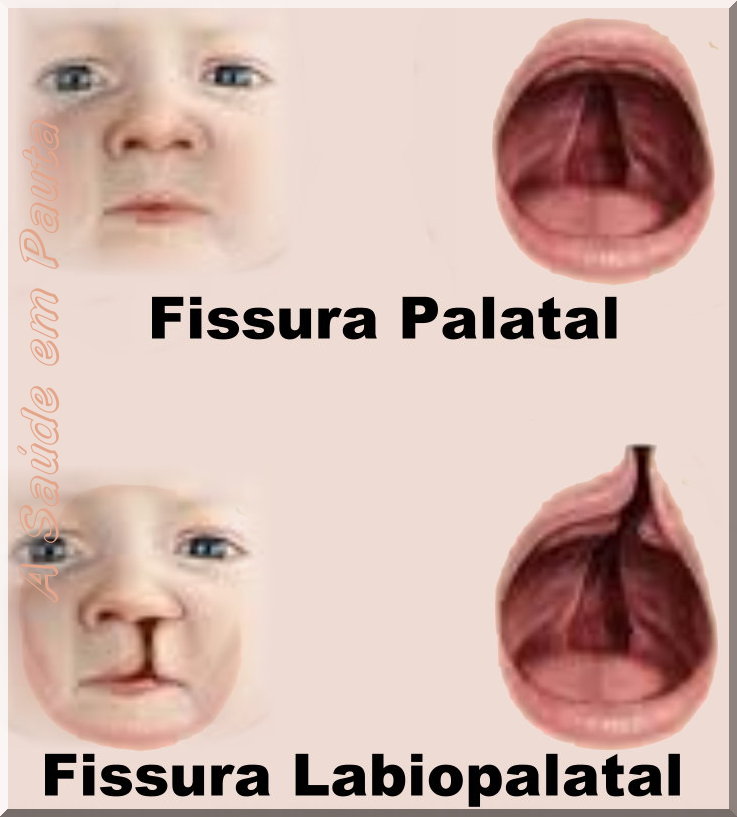 I Seminário de Enfermagem na atenção ao fissurado labiopalatal nesta ...