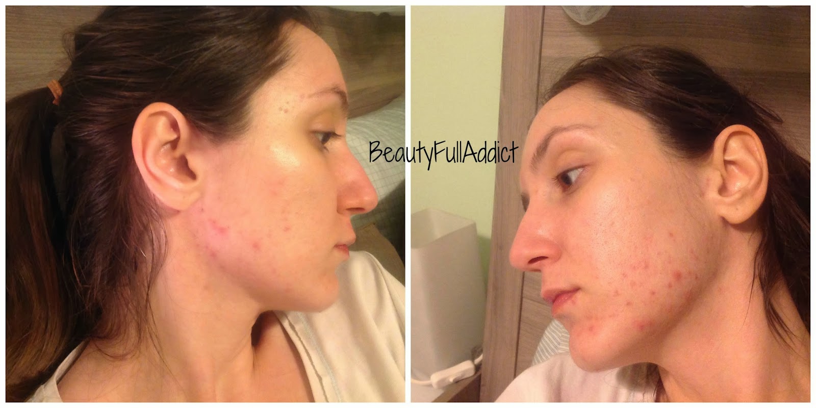 BeautyFull Addict: Taking the Acne train Vol.II Before & After Pictures ...