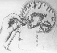 Life and School: Lobotomy also known as Leucotomy.