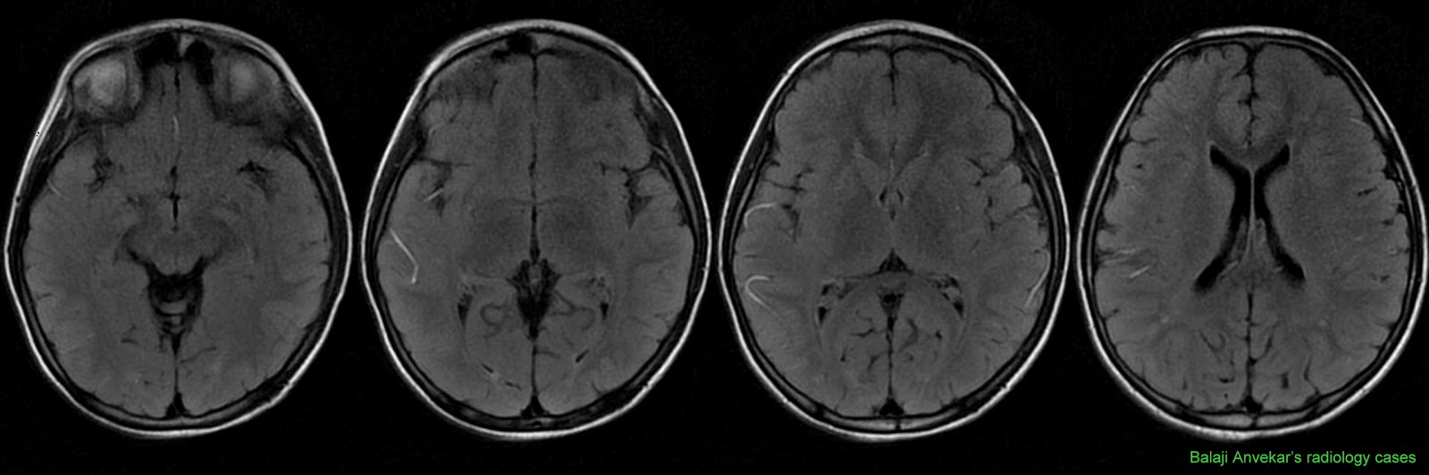 Dr Balaji Anvekar FRCR: IVY sign Moyamoya disease MRI