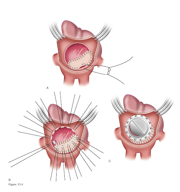 Surgery of the Left Heart Valve Infective Endocarditis - pediagenosis