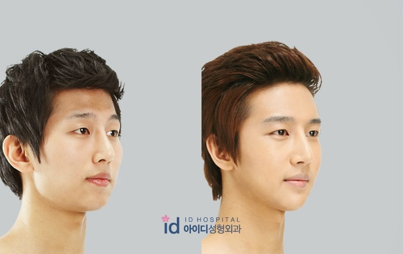 ID Hospital Korea: What is cheekbone reduction surgery? And why do we ...