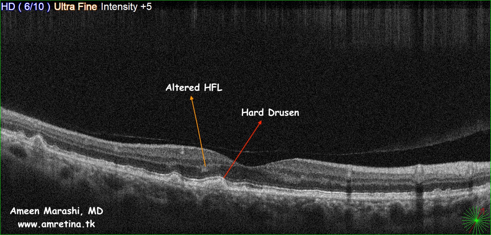 Drusen in non-neovascular ARMD and subtypes