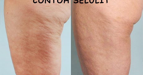 Teh hijau Apakah Benar-benar Dapat Membakar lemak? | Apa Penyebab ...