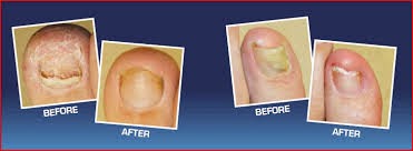 Medical Treatment Pictures-for Better Understanding: Nail Removal ...