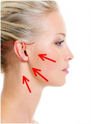 Dra. Vanessa Thielen Gracia - Cirujano Plástico: Lifting de papada