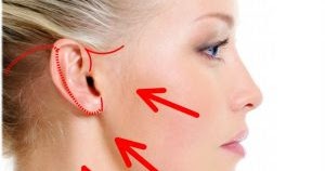 Dra. Vanessa Thielen Gracia - Cirujano Plástico: Lifting de papada