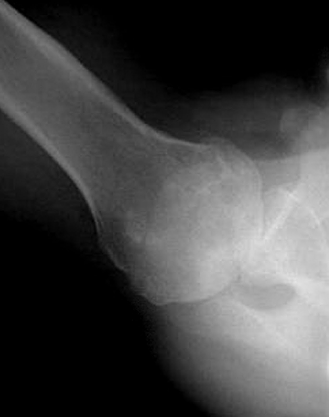 UW Shoulder and Elbow Academy: Anatomy of the glenoid on axillary x ...